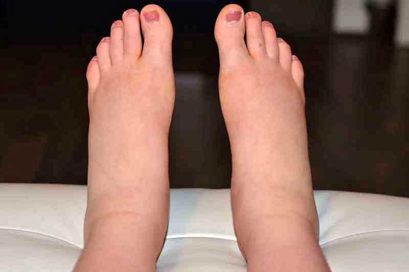 Waspada Kutu Air! Cari Tahu Penyebab dan Cara Ampuh Menceganya ...