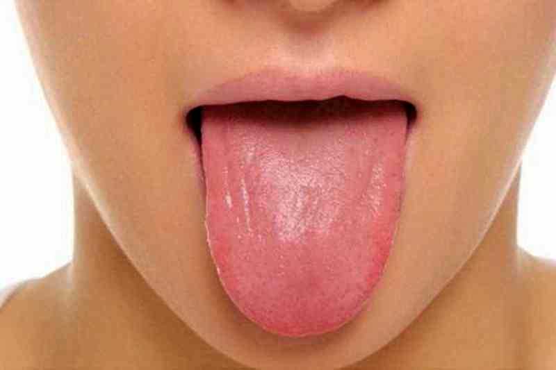 Kondisi Kesehatan Bisa Dilihat dari Warna Lidah | BALIPOST.com