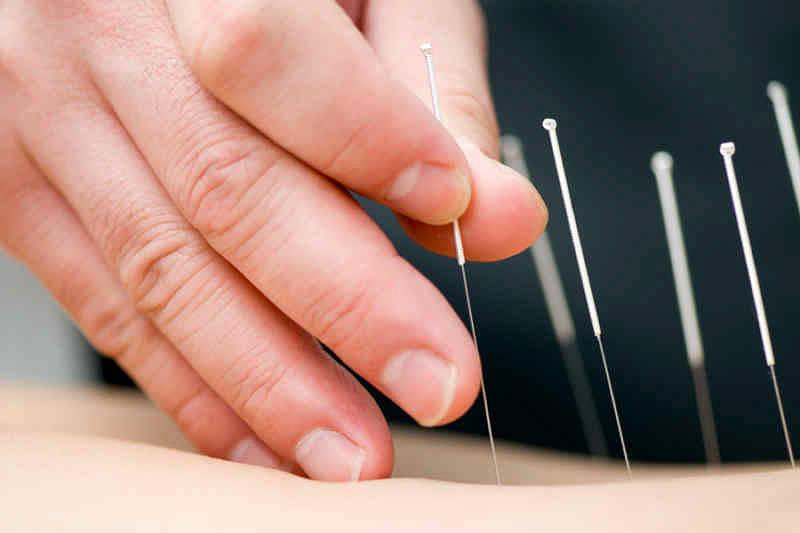 Ini, Bedanya Akupuntur dan Akupresur | BALIPOST.com
