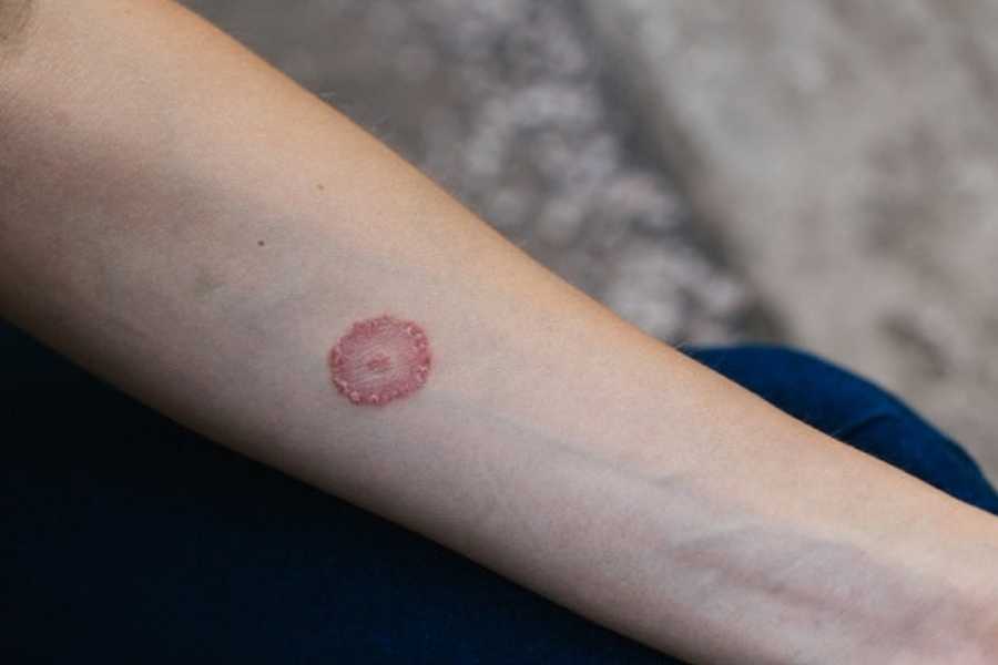 Jangan Anggap Sepele Kurap! Kenali Gejalanya | BALIPOST.com