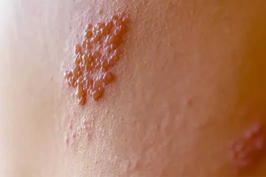Kenali Herpes Zoster, Kondisi Kulit Ruam Akibat Virus | BALIPOST.com